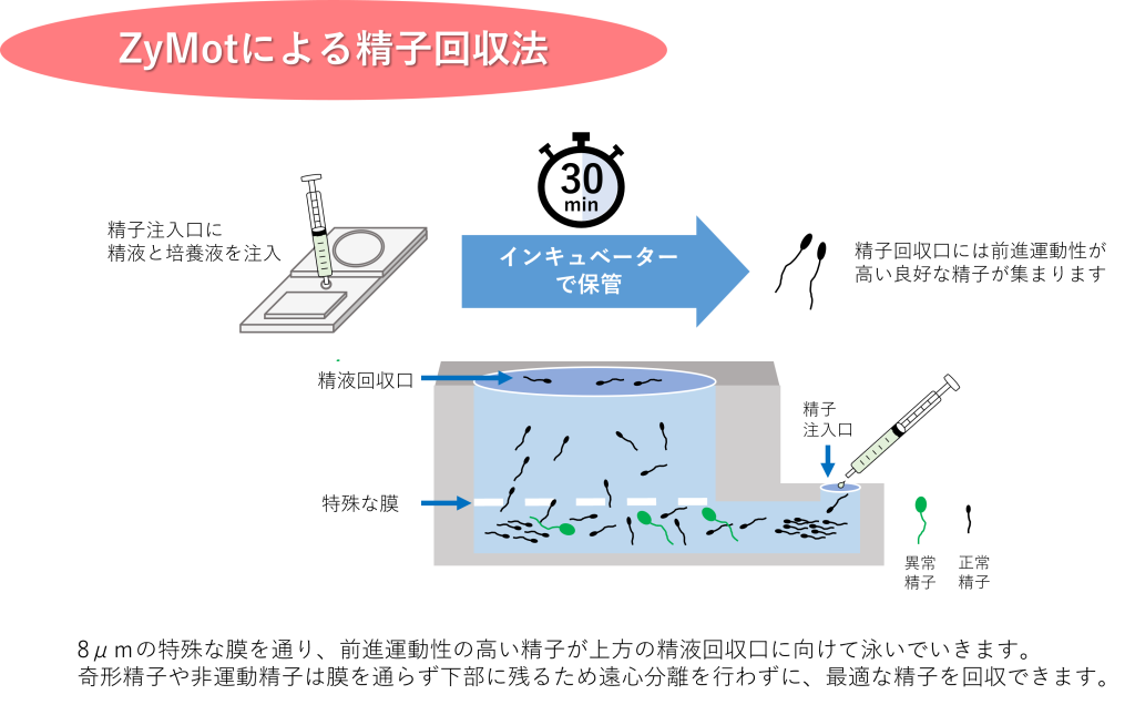 ZyMot（ザイモート）が先進医療にて実施可能となりました ｜ 仙台ソレイユ母子クリニック